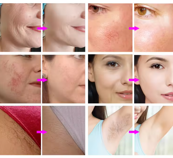 Gold Opt Ipl / Shr Multifunctional Fast Hair Removal – Top Seller ...